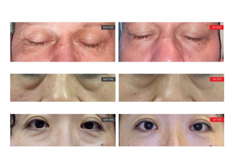 Traitement Laser Fotona SmoothEye ⋆ Ekinoxe ⋆ Clinique d'esthétique à ...